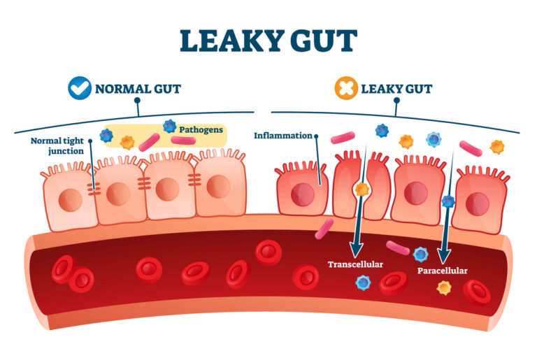 Microbiote intestinal - SIBO & CANDIDOSE - Santé intestinale - Laurence ...